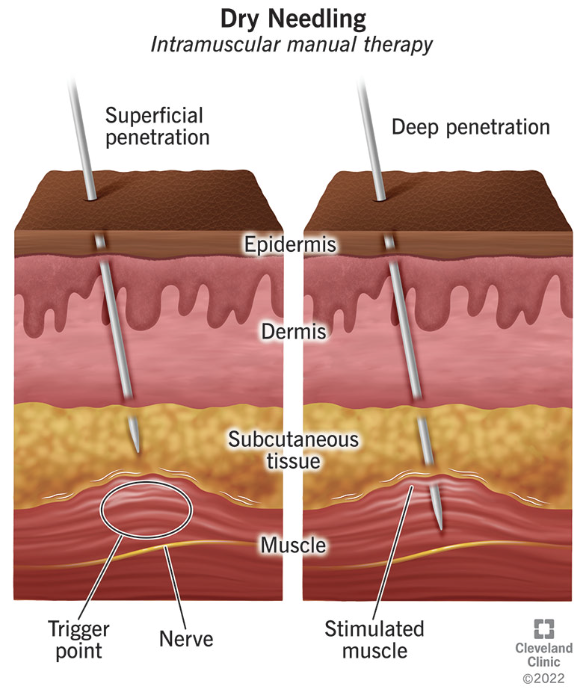 Dry Needling – U-District PT